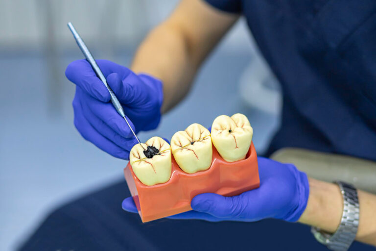 Tooth Decay, Causes, Precautions and Treatment - Aesthetic Dental Clinic